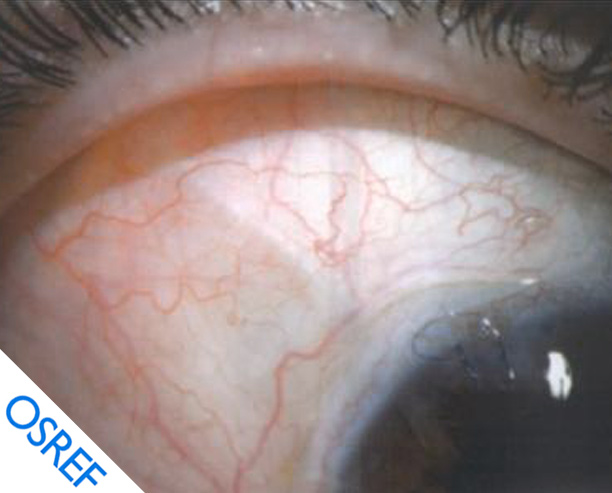 Glaucoma Indications - Osref