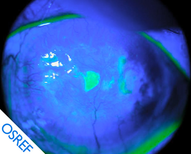 Amniotic Membrane Transplantation for Corneal Indications - Osref
