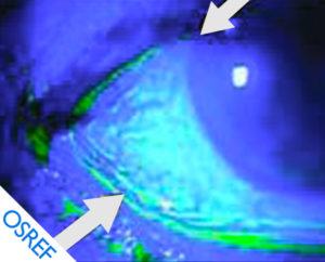 Conjunctivochalasis (CCh) - Osref