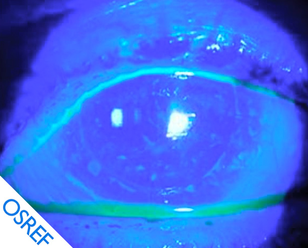 Amniotic Membrane Transplantation for Corneal Indications - Osref