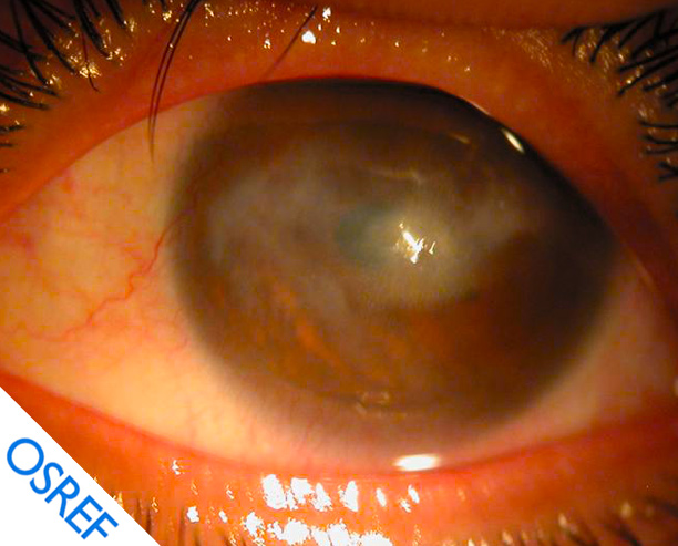Amniotic Membrane Transplantation for Corneal Indications - Osref