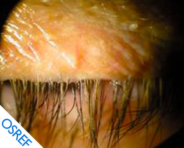Demodex Blepharitis: Diagnosis and Treatment - Osref
