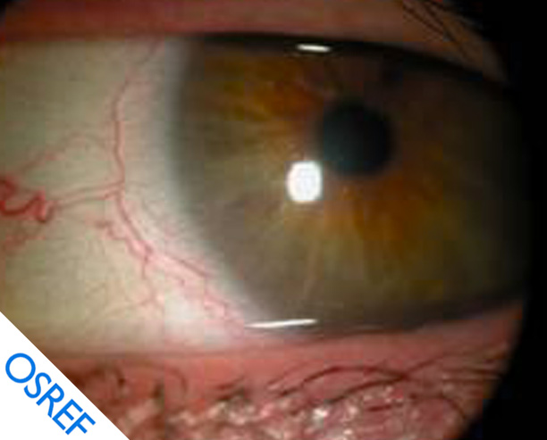 Demodex Blepharitis Diagnosis And Treatment Osref