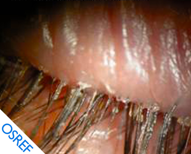 Demodex Blepharitis Diagnosis And Treatment Osref