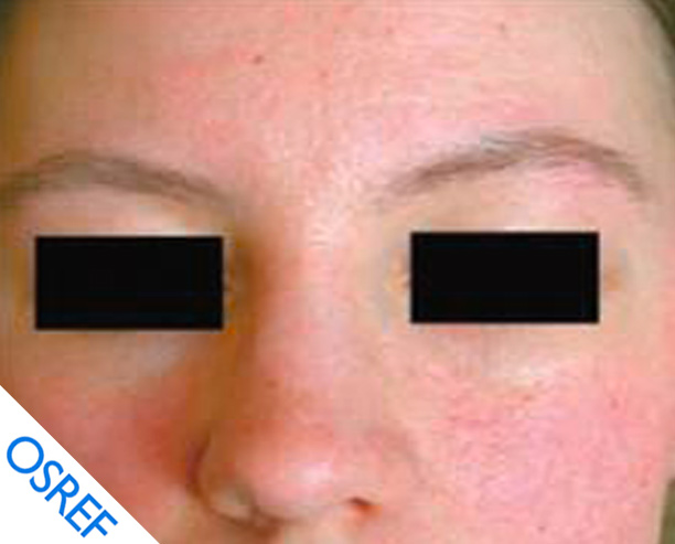 Demodex Blepharitis: Diagnosis and Treatment - Osref