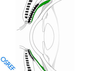 Fornix Reconstruction - Osref