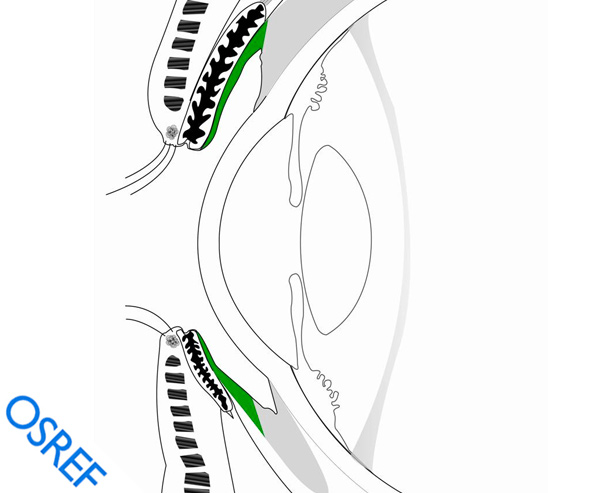 Fornix Reconstruction - Osref