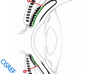 Fornix Reconstruction - Osref