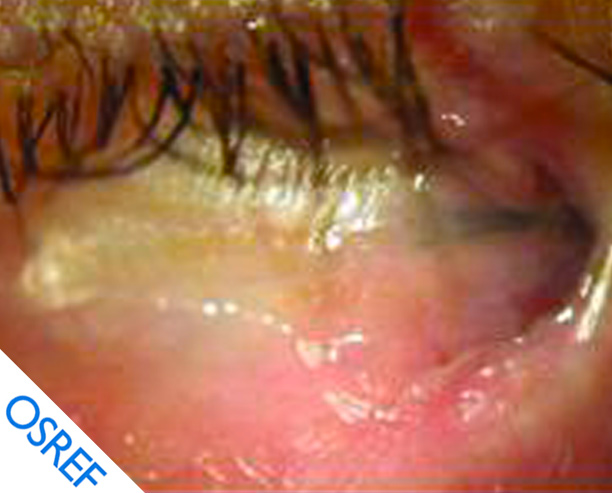 Fornix Reconstruction - Osref