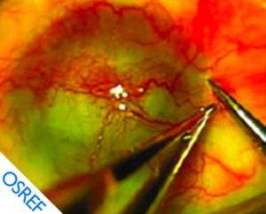 Fornix Reconstruction - Osref
