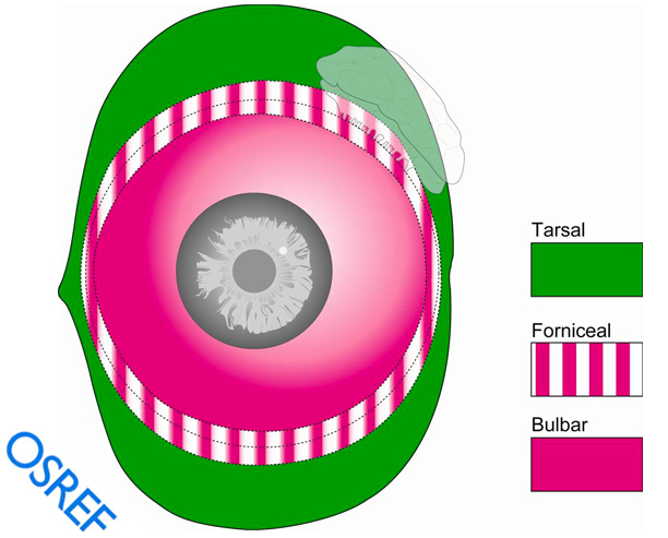 Fornix Reconstruction - Osref