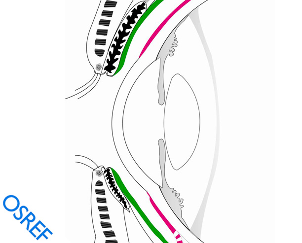 Fornix Reconstruction - Osref
