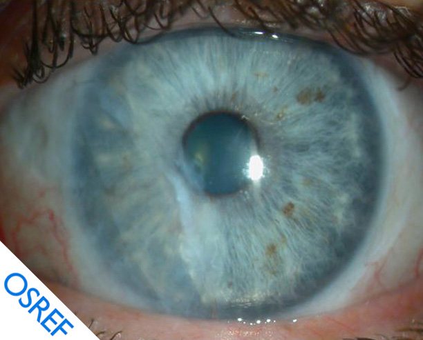 Pterygium & Pinguecula - Osref