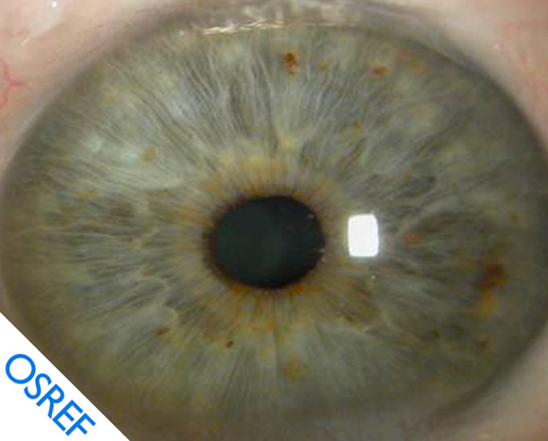 Amniotic Membrane Transplantation for Limbal Stem Cell Deficiency - Osref